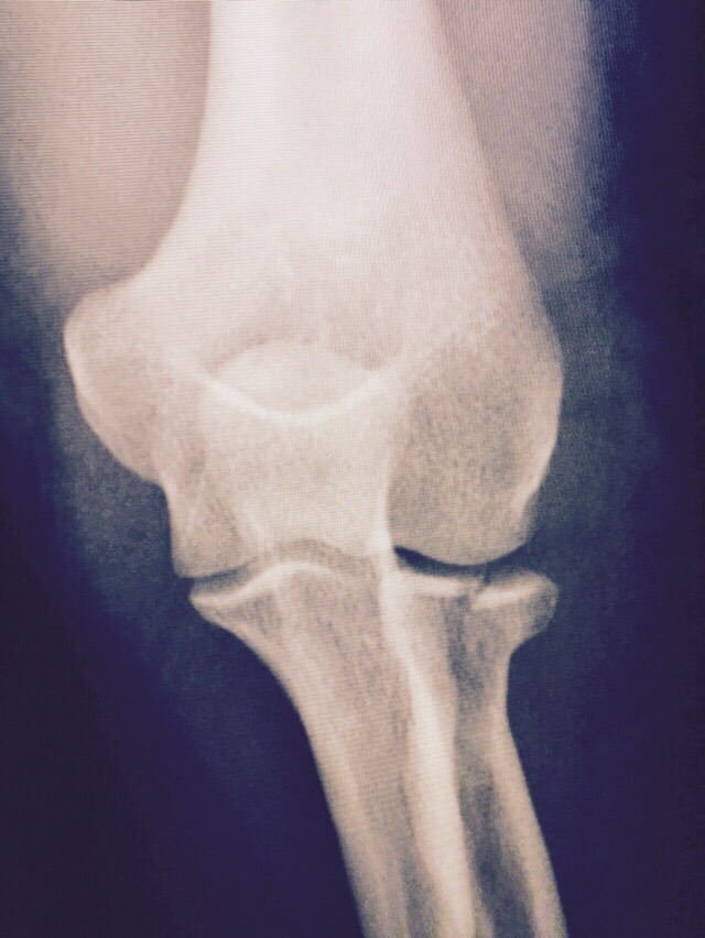 Radial Head Fractures - Trauma - Orthobullets
