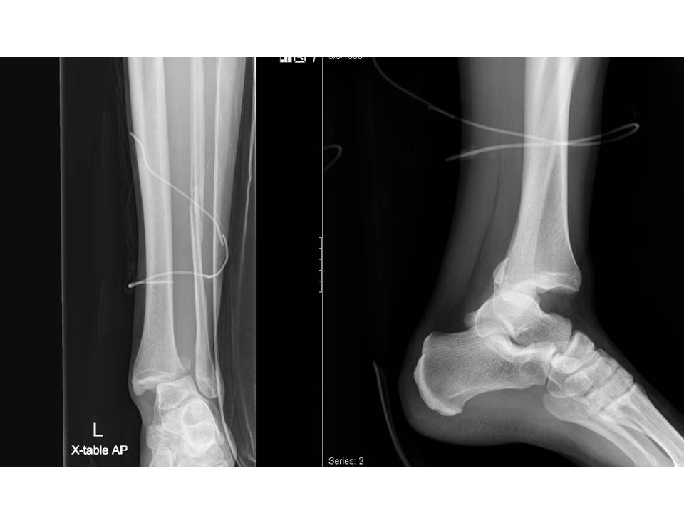 Ankle Fractures - Trauma - Orthobullets.com