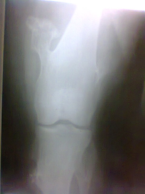 Chondroblastoma - Pathology - Orthobullets