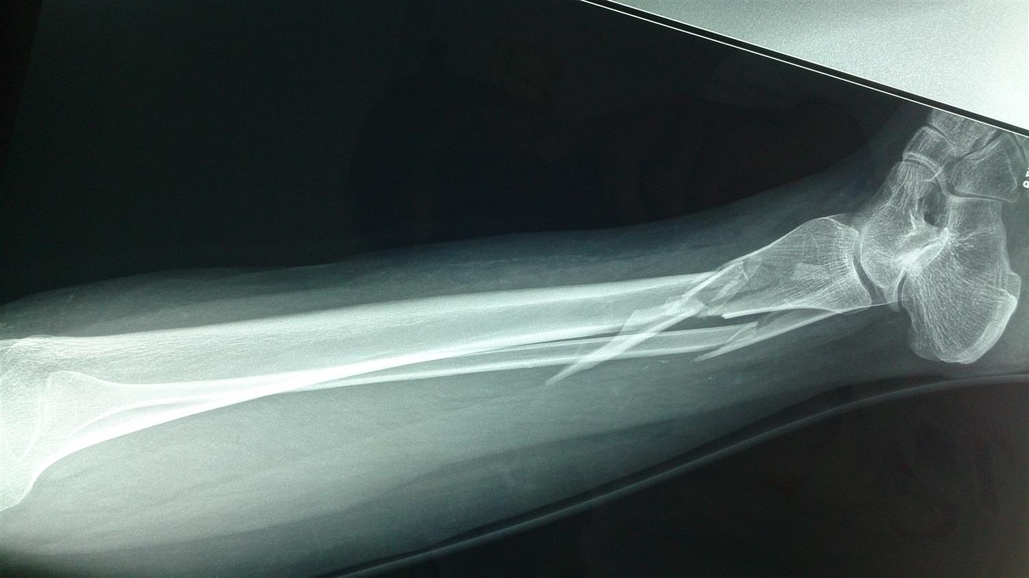 Tibia Shaft Fractures - Trauma - Orthobullets.com