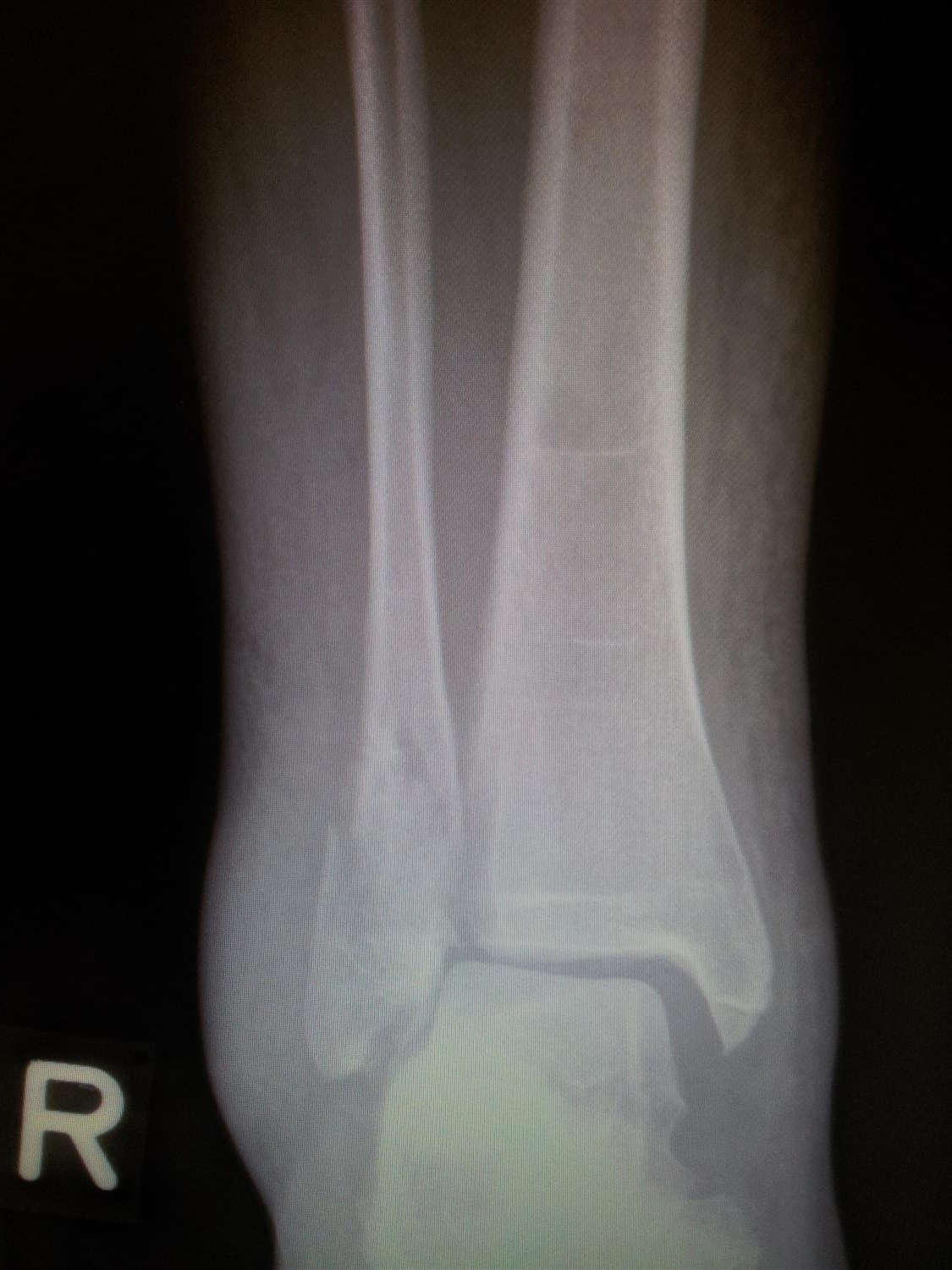 Ankle Fractures - Trauma - Orthobullets.com