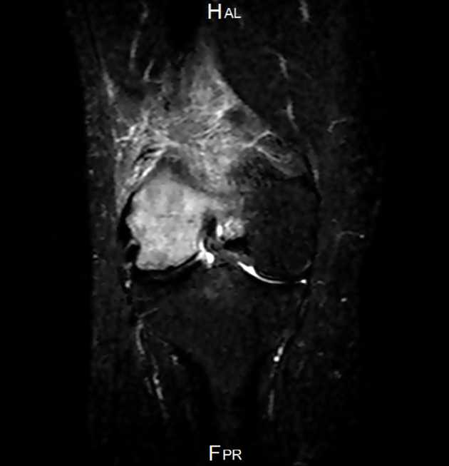 Osteonecrosis Of The Knee Knee Sports Orthobullets