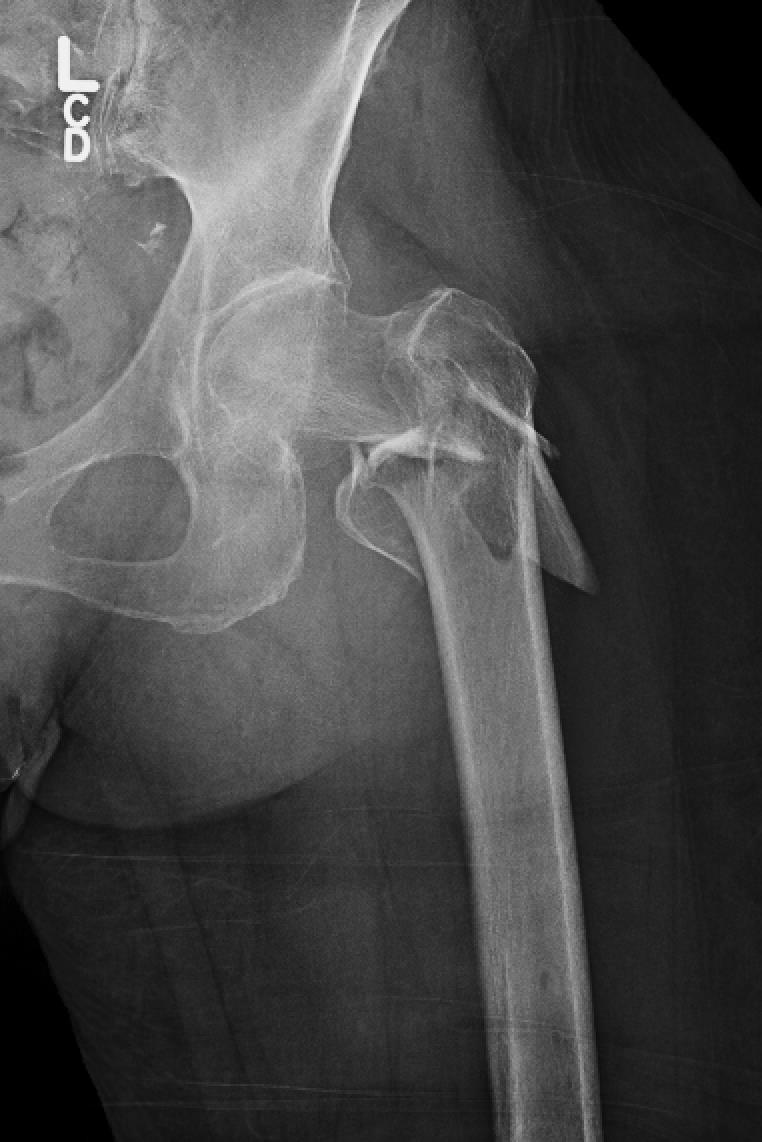 Subtrochanteric Fractures - Trauma - Orthobullets