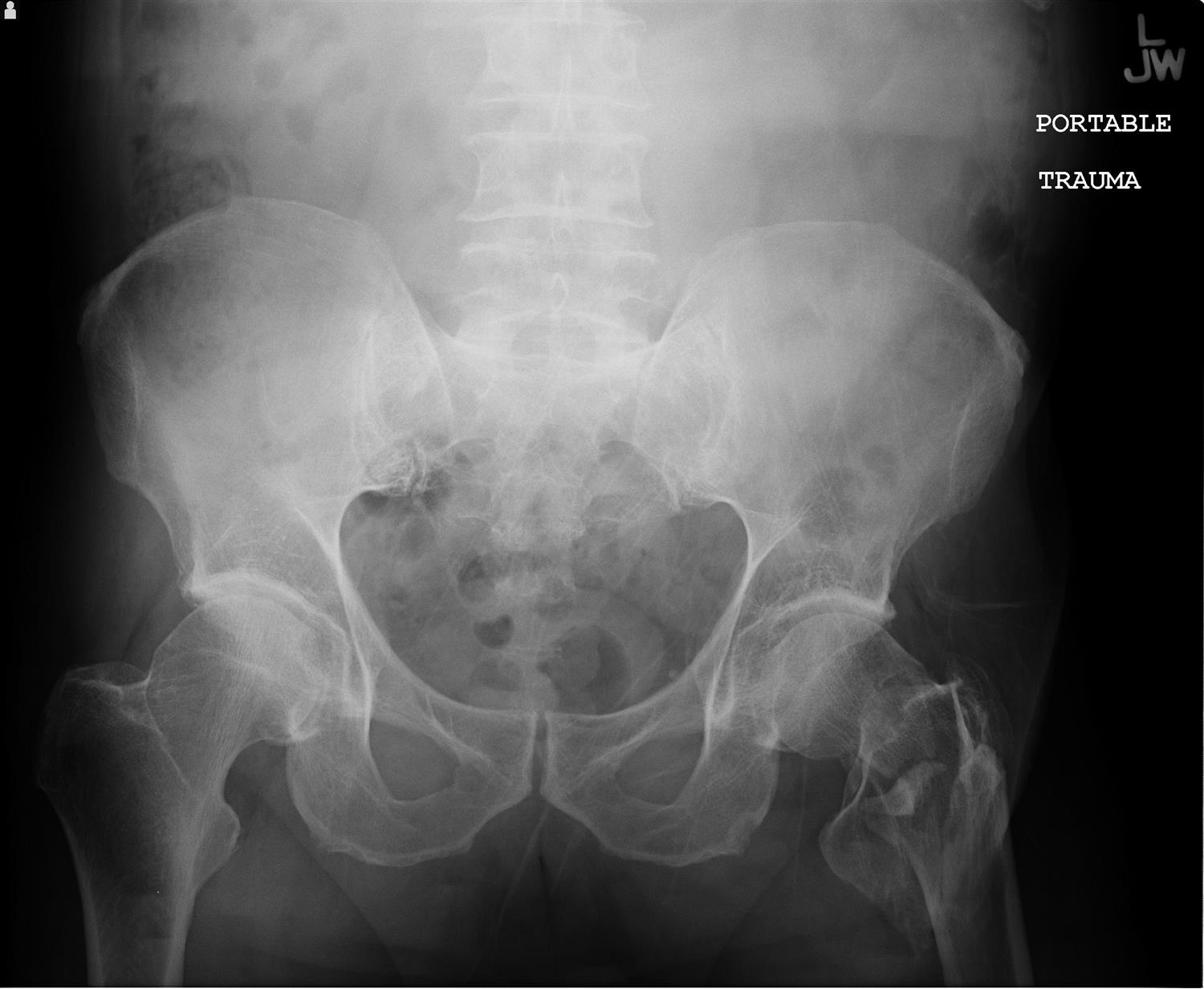 Intertrochanteric Fractures - Trauma - Orthobullets