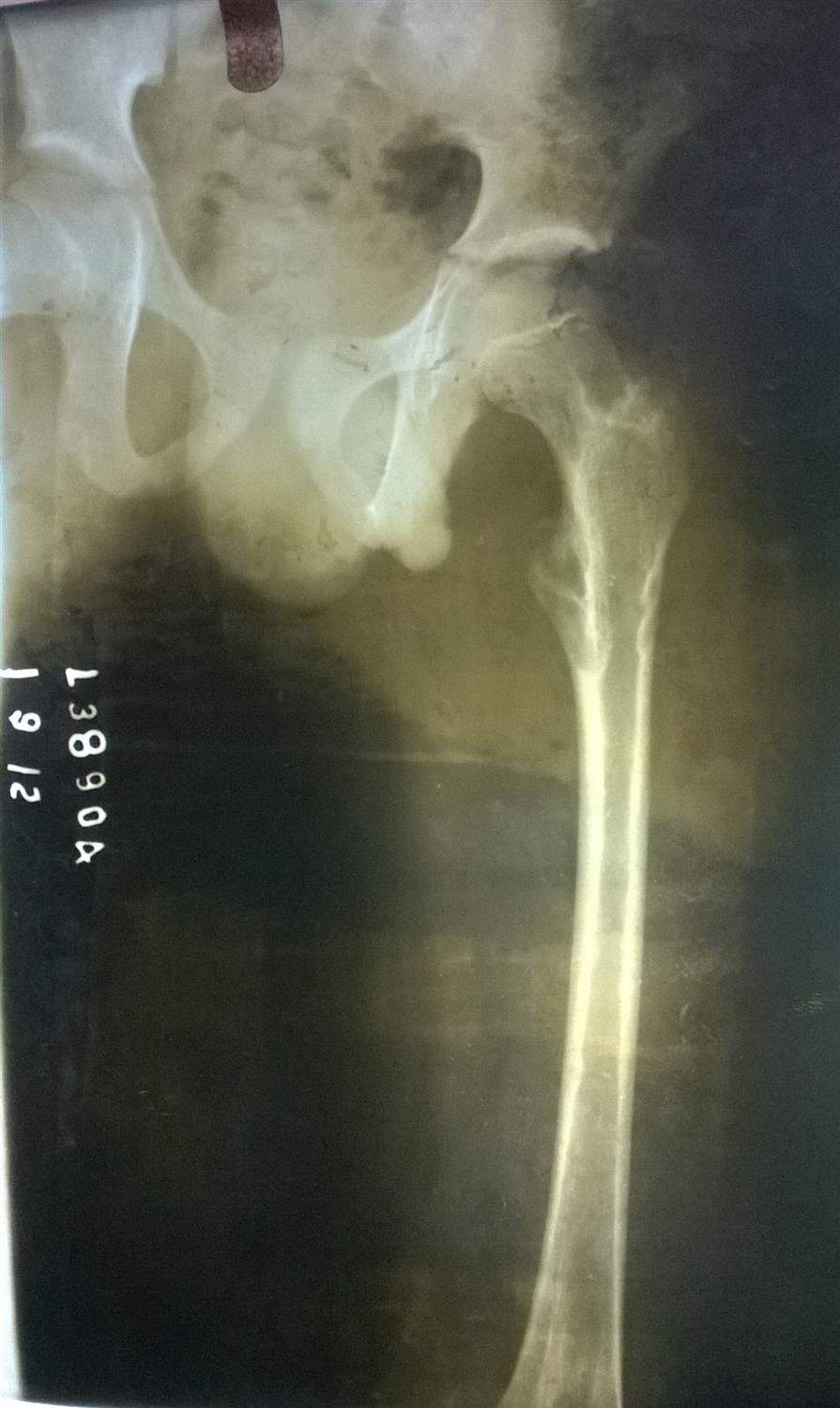 Enchondromas - Pathology - Orthobullets