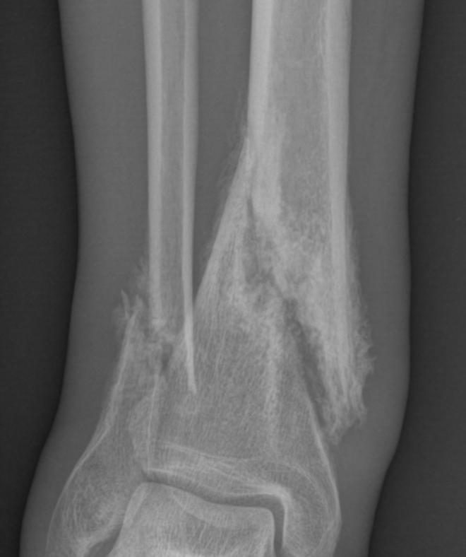 Nonunion - Basic Science - Orthobullets