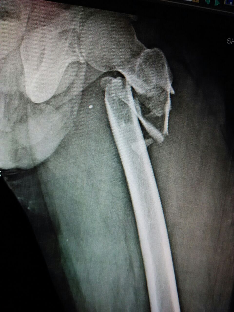 Subtrochanteric Fractures - Trauma - Orthobullets