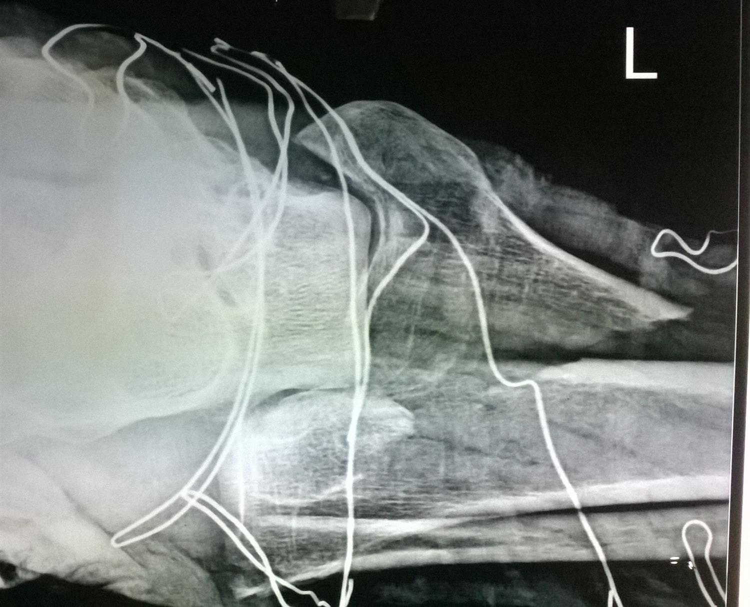Ankle Fractures - Trauma - Orthobullets.com