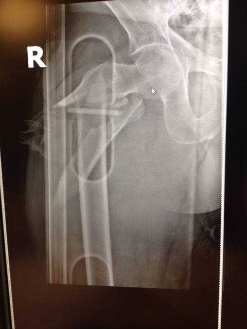 Subtrochanteric Fractures - Trauma - Orthobullets