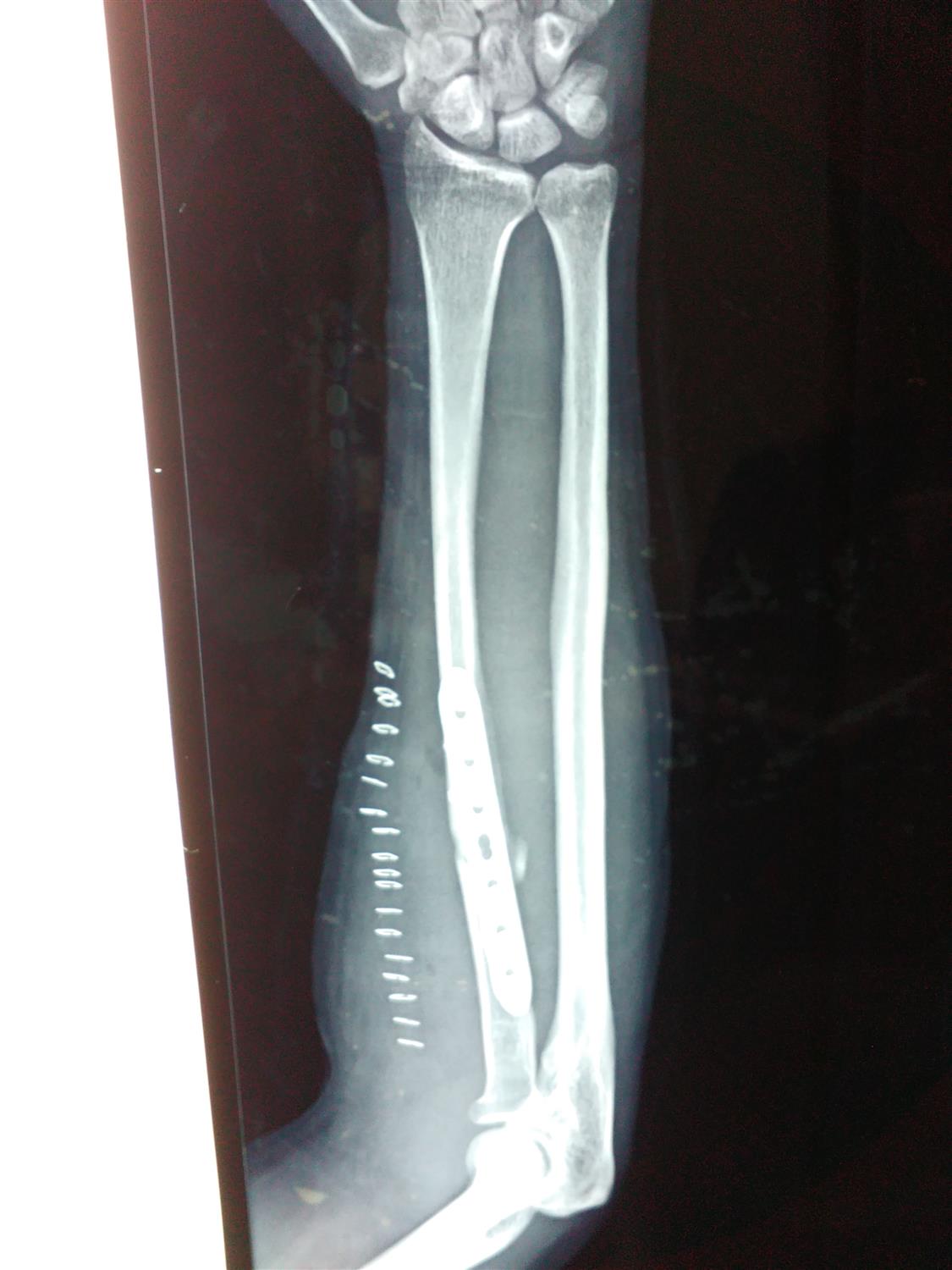 Radioulnar Synostosis - Trauma - Orthobullets