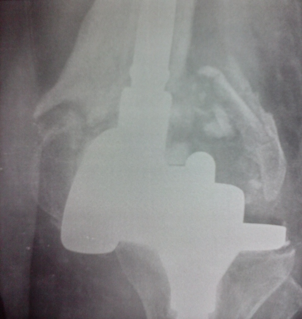 TKA Revision - Recon - Orthobullets