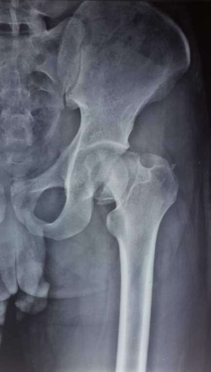 Femoral Head Fractures - Trauma - Orthobullets