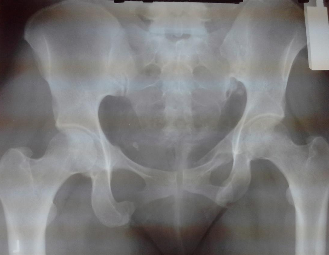 Pelvic Ring Fractures Trauma Orthobullets