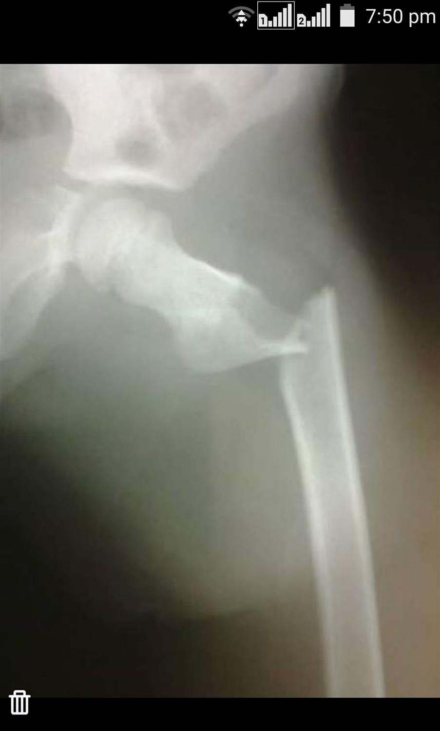 Femoral Shaft Fractures - Pediatric - Pediatrics - Orthobullets