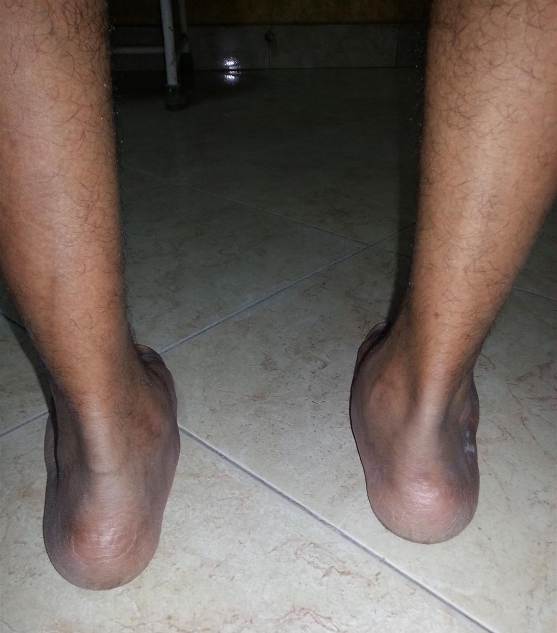 Tarsal Navicular Fractures - Foot & Ankle - Orthobullets