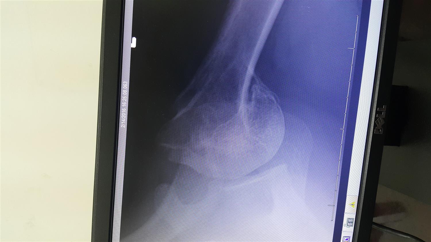 Proximal Humerus Fractures - Trauma - Orthobullets