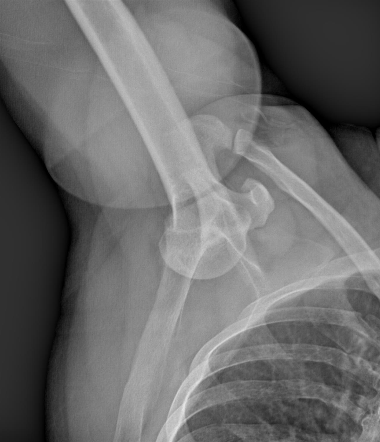 Luxatio Erecta (Inferior Glenohumeral Joint Dislocation) - Shoulder ...