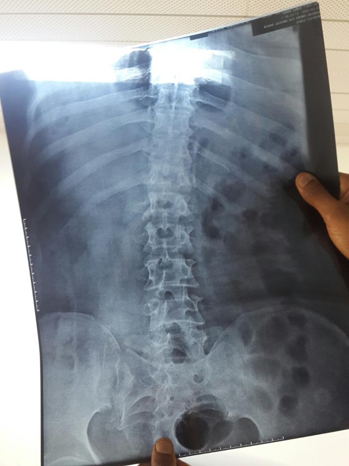 Pelvic Ring Fractures - Trauma - Orthobullets