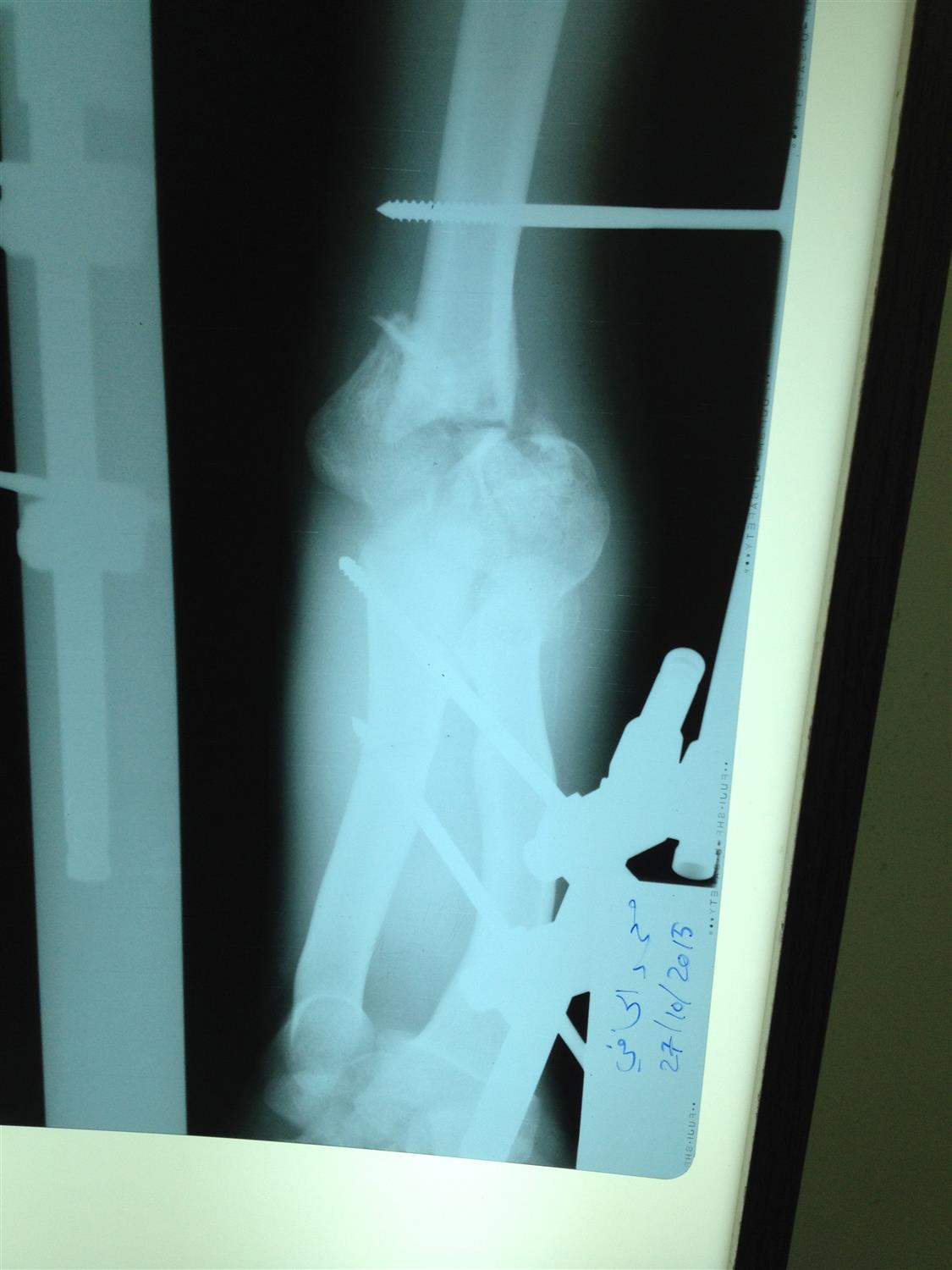 Distal Humerus Fractures - Trauma - Orthobullets