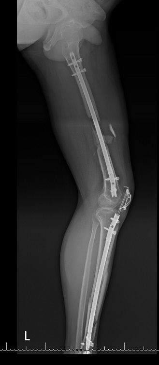 Femoral Shaft Fractures - Trauma - Orthobullets.com