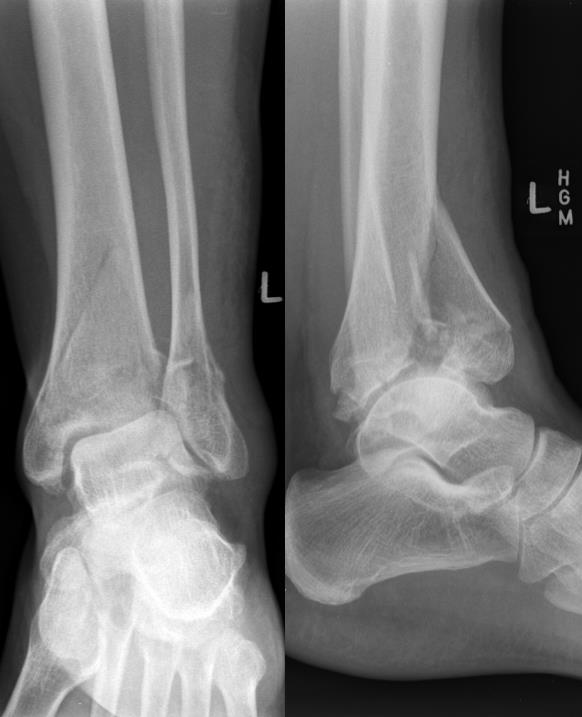 Tibial Plafond Fractures - Trauma - Orthobullets