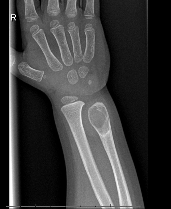 Aneurysmal Bone Cyst - Pathology - Orthobullets