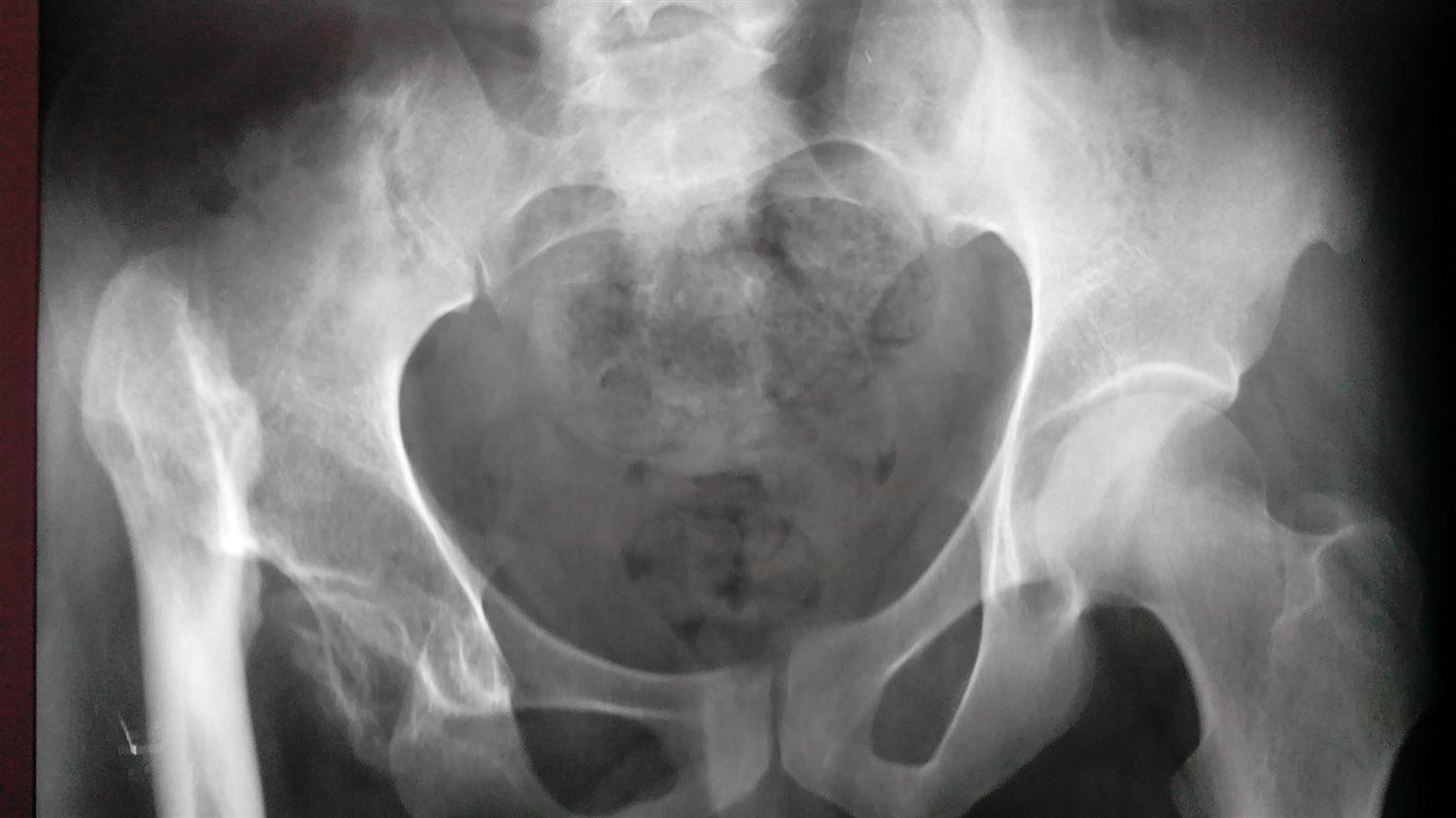 Proximal Femur Fractures - Pediatric - Pediatrics - Orthobullets