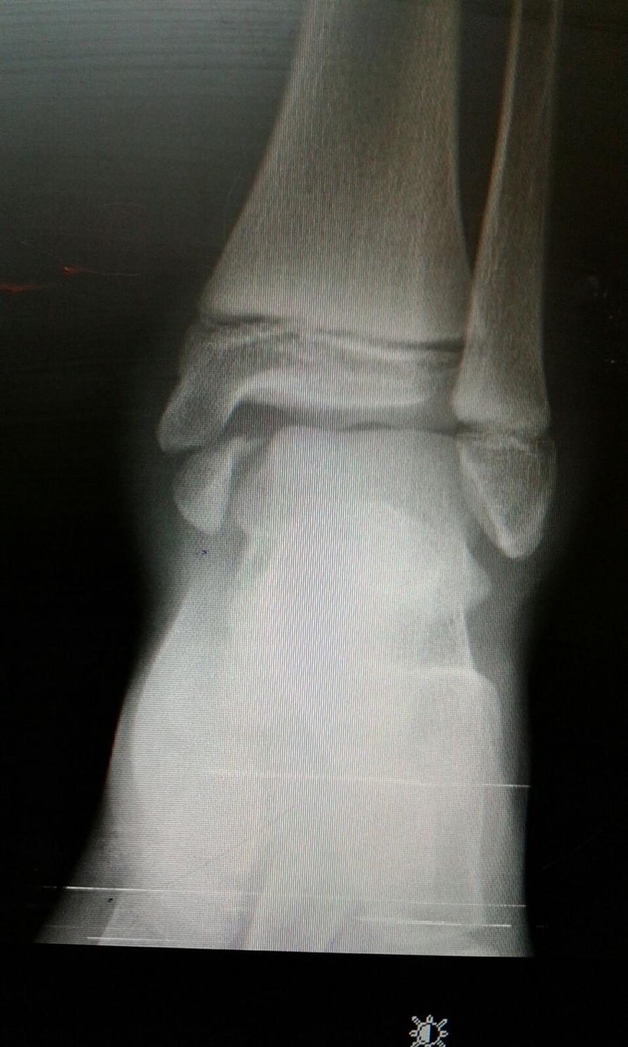 Ankle Fractures - Pediatric - Pediatrics - Orthobullets