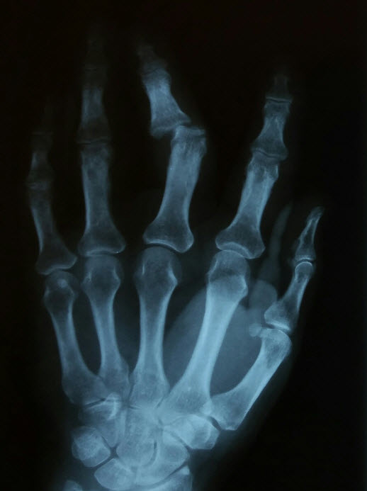 Phalanx Dislocations - Hand - Orthobullets