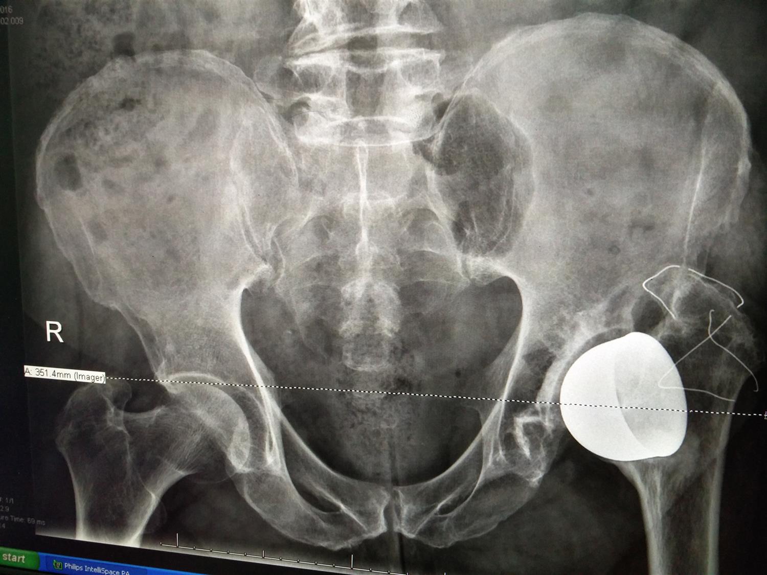 THA Other Complications - Recon - Orthobullets