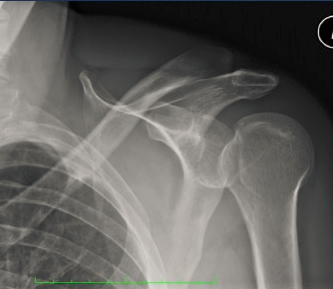 Posterior Shoulder Instability & Dislocation - Shoulder & Elbow ...