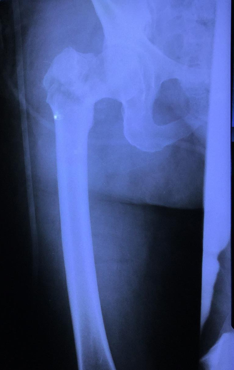 Intertrochanteric Fractures - Trauma - Orthobullets