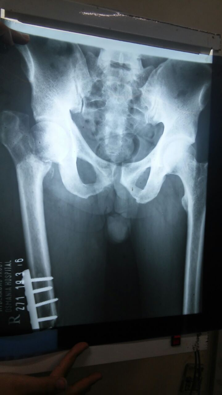 Femoral Neck Fractures - Trauma - Orthobullets