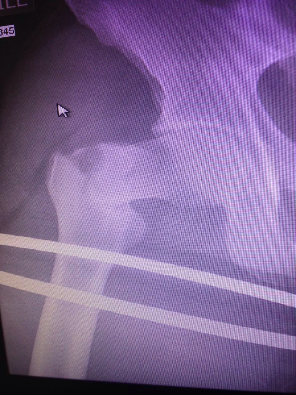 Intertrochanteric Fractures - Trauma - Orthobullets
