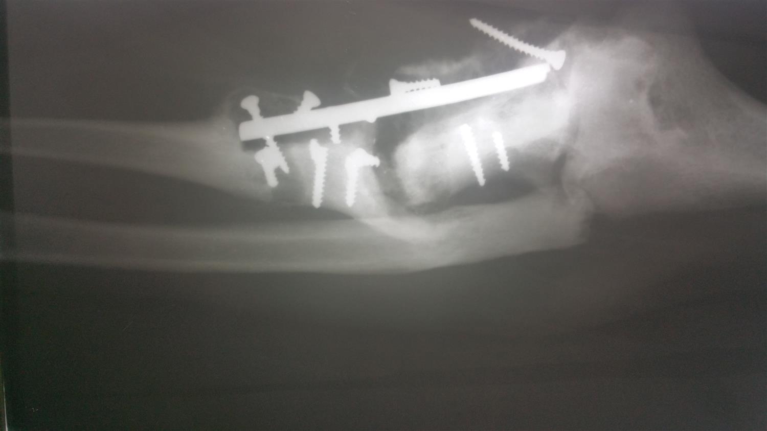 Radius and Ulnar Shaft Fractures - Trauma - Orthobullets