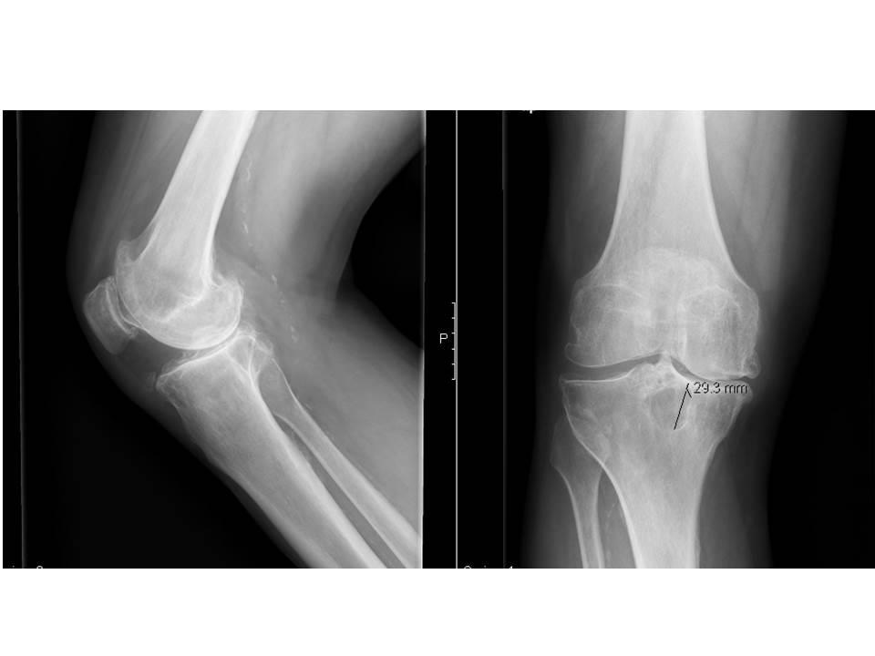 TKA Prosthesis Design - Recon - Orthobullets