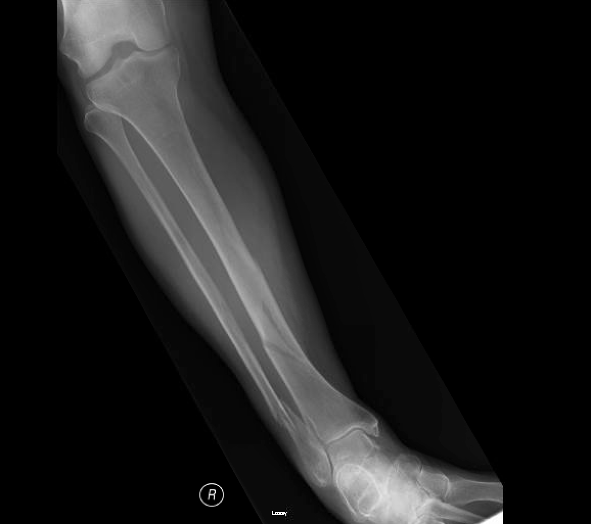 Tibia Shaft Fractures - Trauma - Orthobullets.com