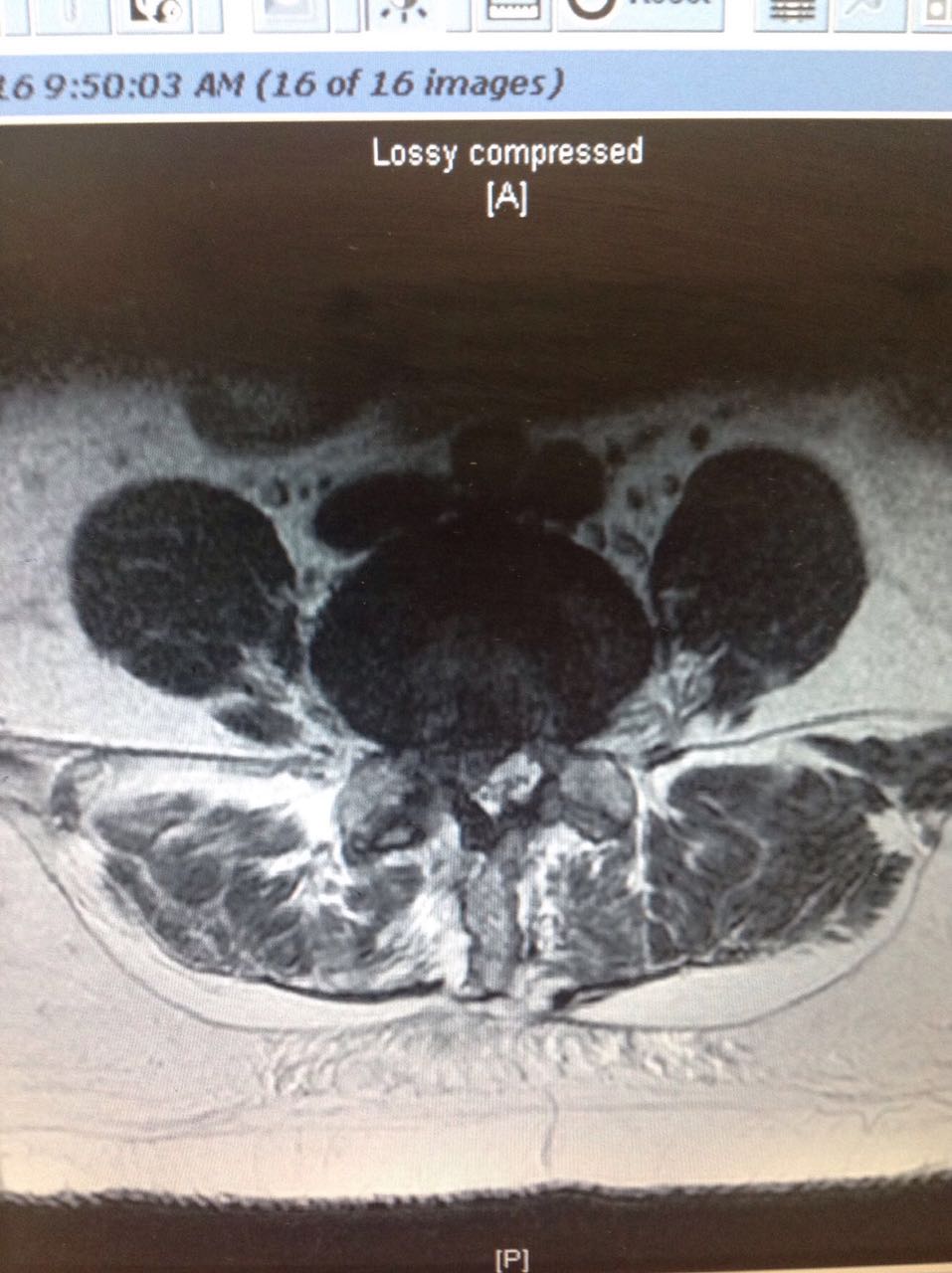 Lumbar Disc Herniation - Spine - Orthobullets