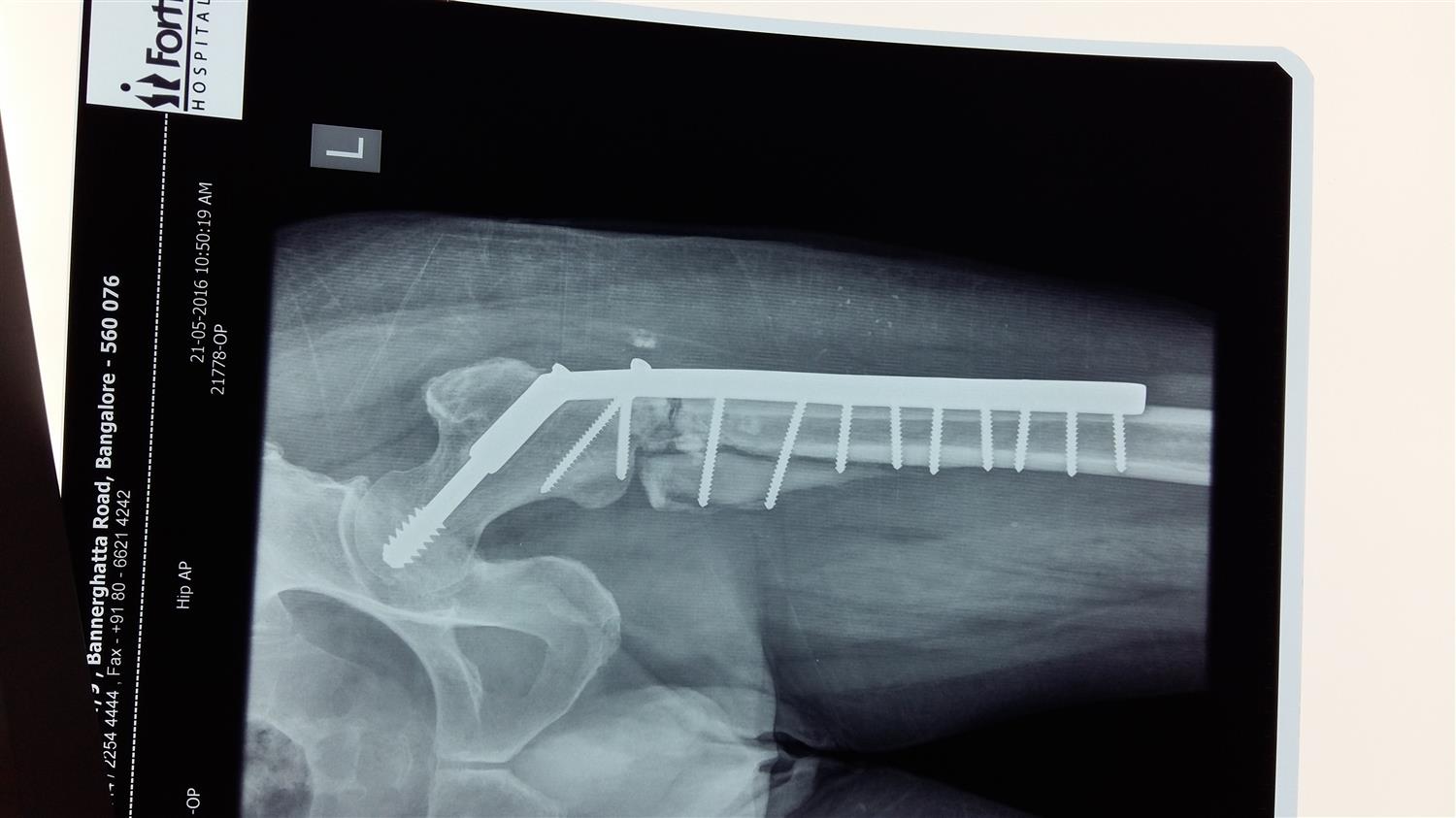 Subtrochanteric Fractures - Trauma - Orthobullets