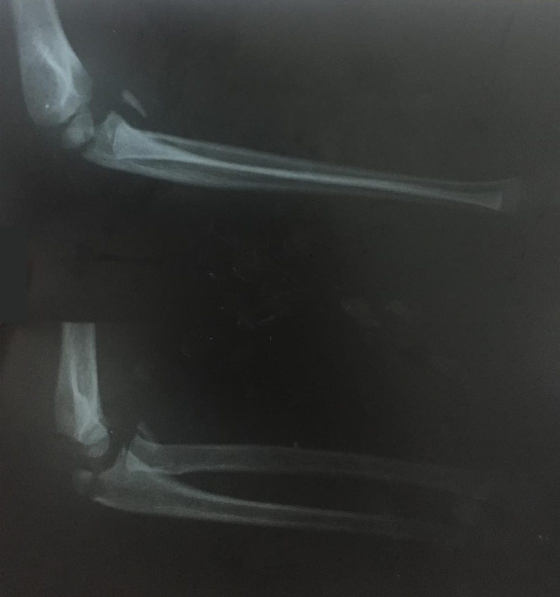 Elbow Dislocation - Pediatric - Pediatrics - Orthobullets