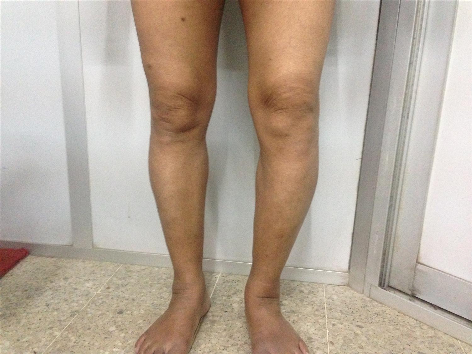 Adamantinoma - Pathology - Orthobullets