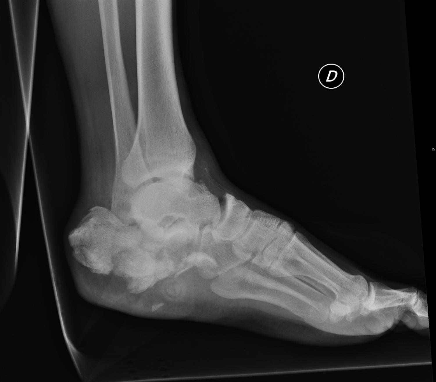 Icd 10 Code For Fracture Of L2