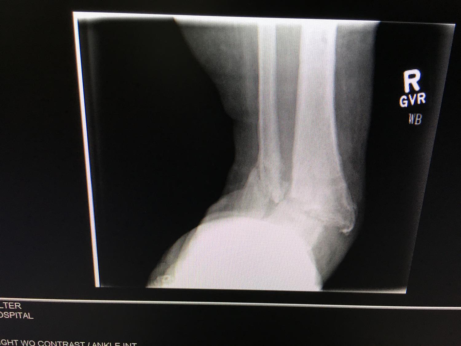Osteomyelitis - Adult - Trauma - Orthobullets