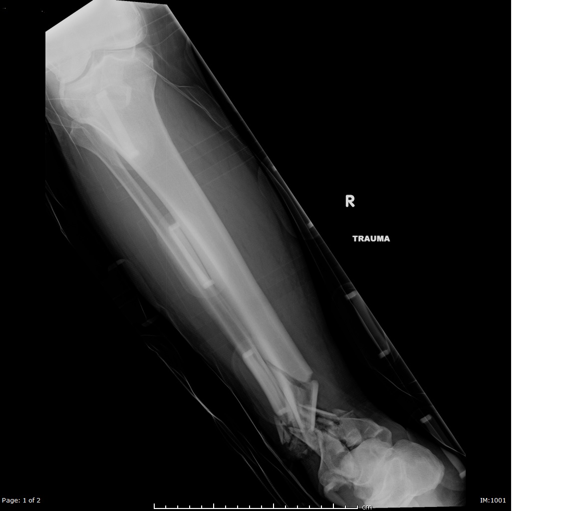 Tibial Plafond Fractures - Trauma - Orthobullets