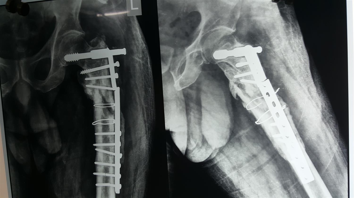Subtrochanteric Fractures - Trauma - Orthobullets