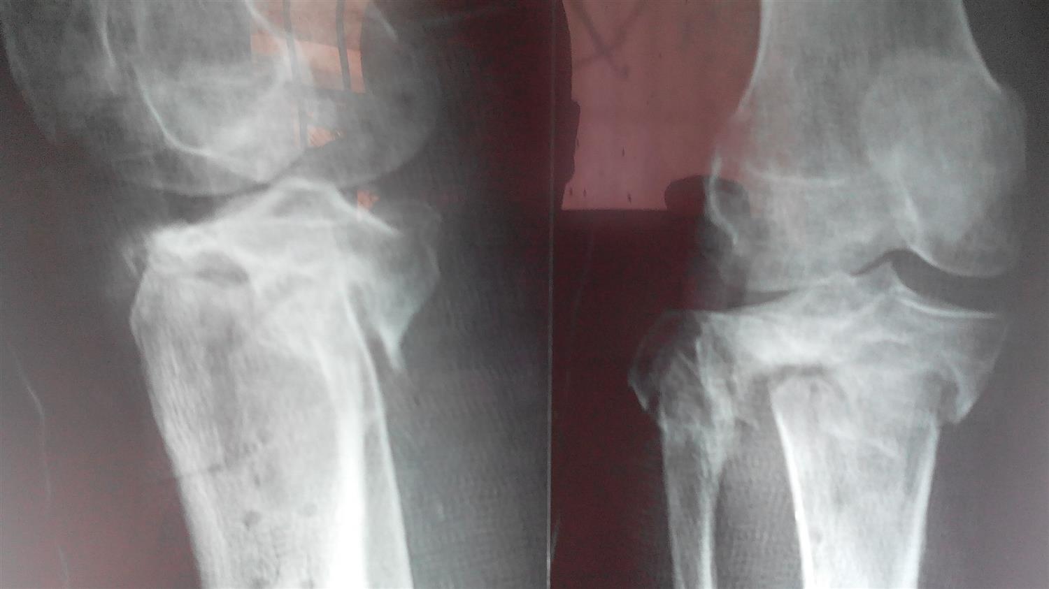 Tibial Plateau Fractures - Trauma - Orthobullets