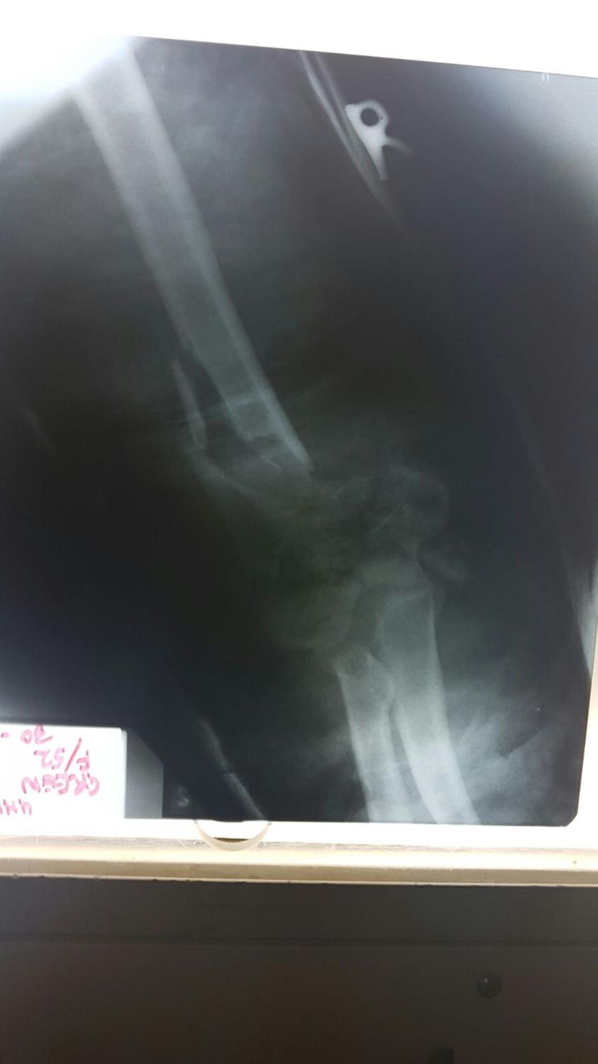 Distal Humerus Fractures - Trauma - Orthobullets