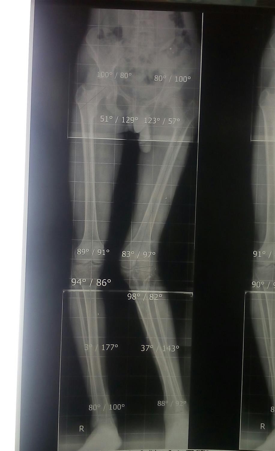 Knee Biomechanics - Recon - Orthobullets