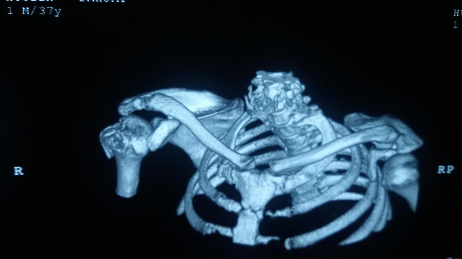 Proximal Humerus Fractures - Trauma - Orthobullets