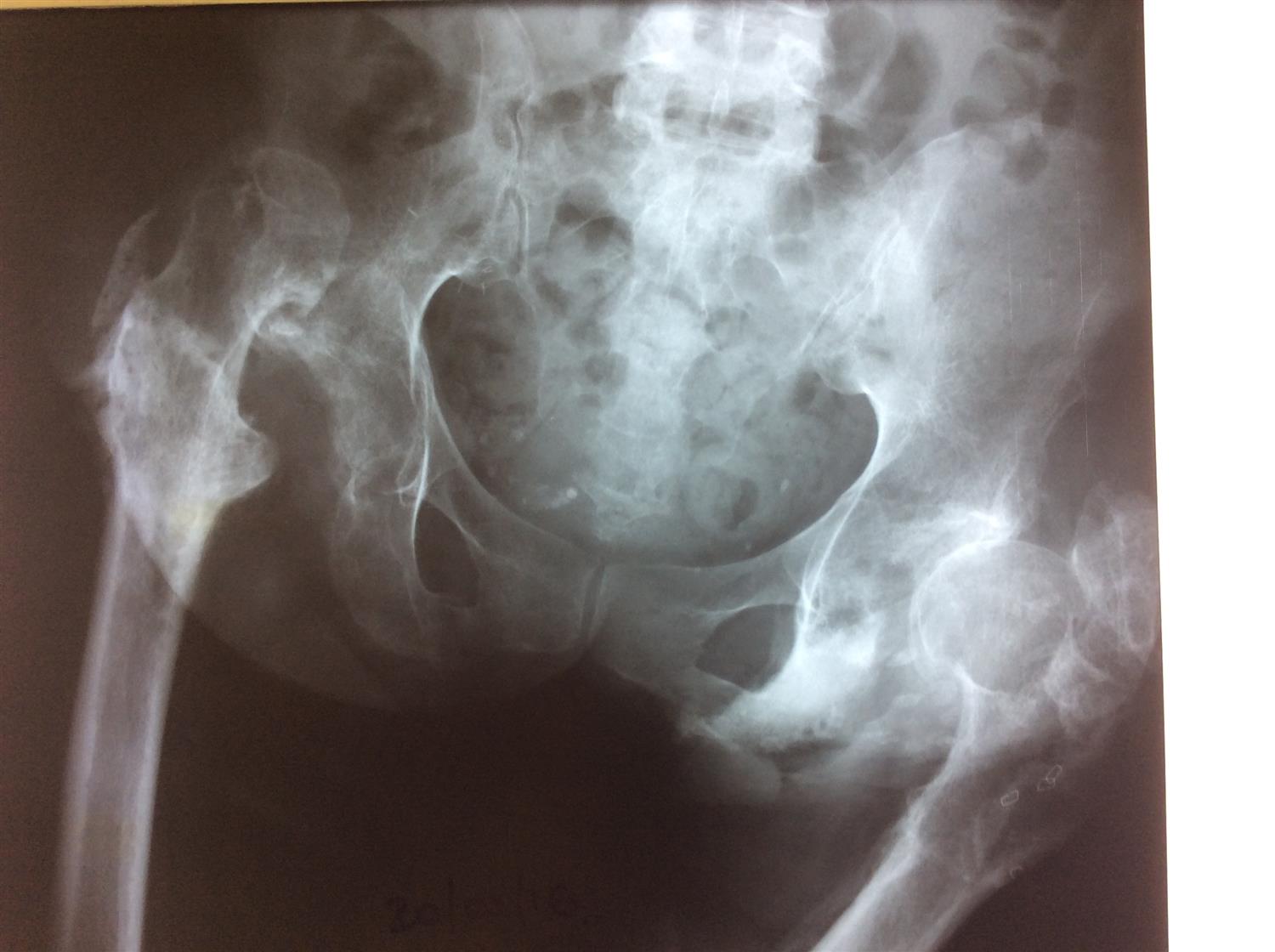 Hip Osteoarthritis - Recon - Orthobullets